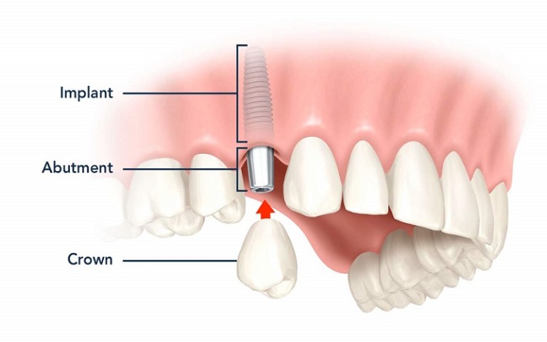 Common Types of Dental Implants – Lets Blog Health